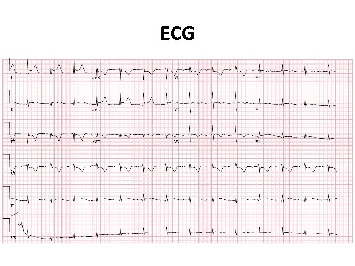 ST Segment Elevation Myocardial Infarction following Valve Replacement