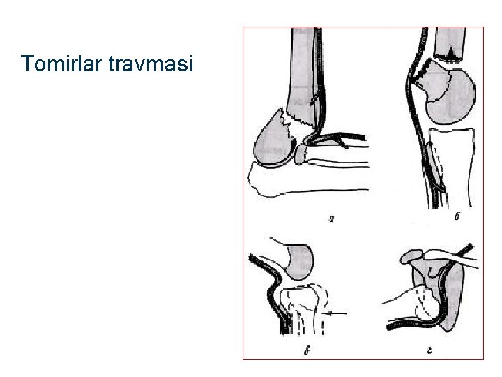 Otkir arterial trombozi va emboliyalari Tarkalganligi Utkir ararial