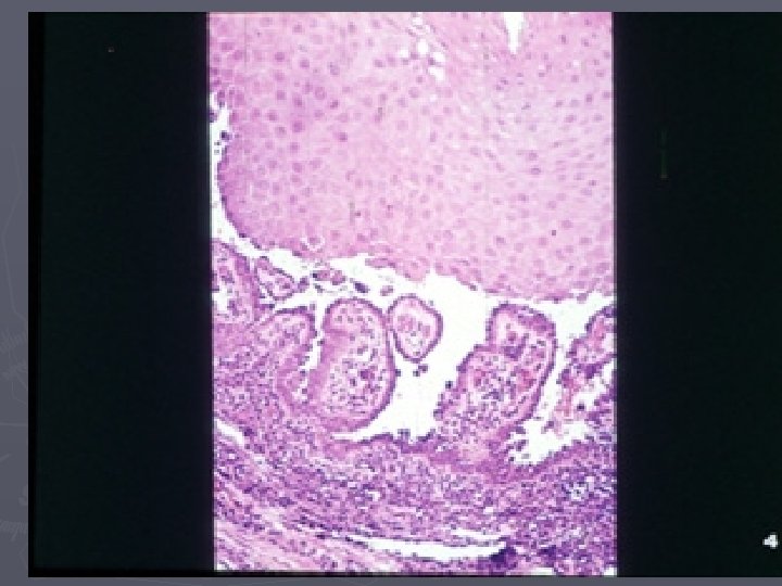 ORAL ULCERATION AND VESICULOBULLOUS LESIONS Ulcer Is a