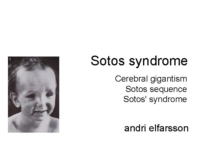 Sotos syndrome Cerebral gigantism Sotos sequence Sotos syndrome