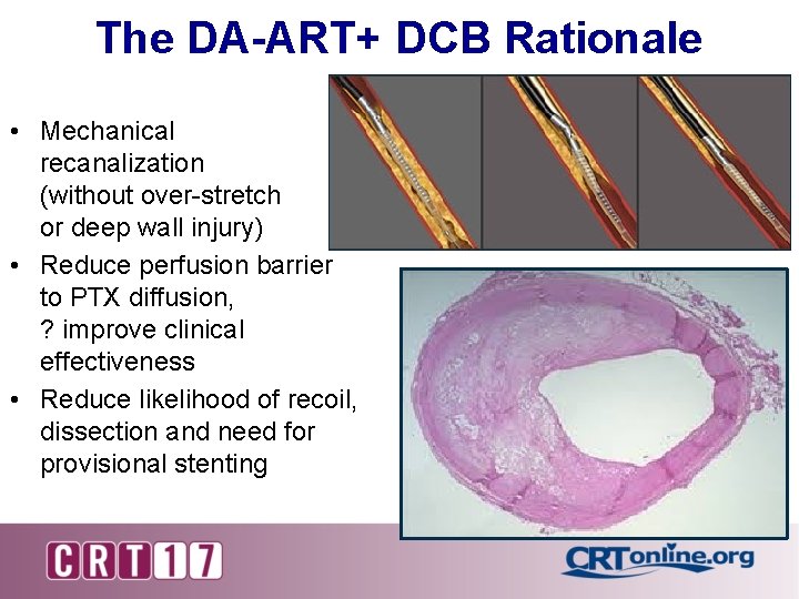 DCB Potential Beyond the Selected SFA Lesions Types