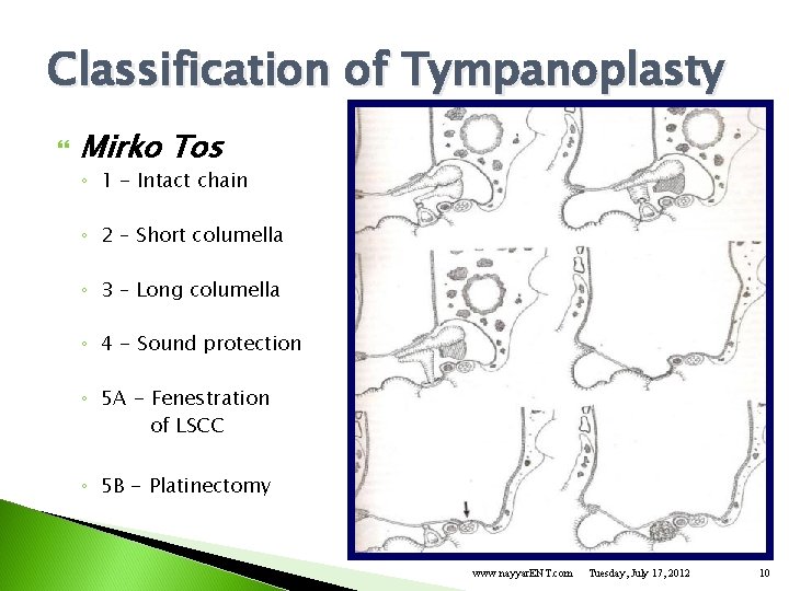 Principles of tympanoplasty By Dr Supreet Singh Nayyar
