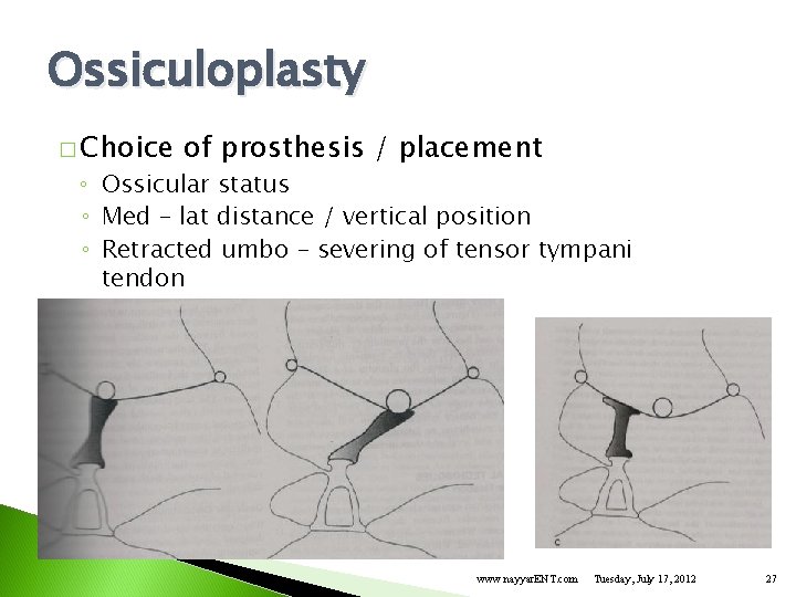 Principles of tympanoplasty By Dr Supreet Singh Nayyar