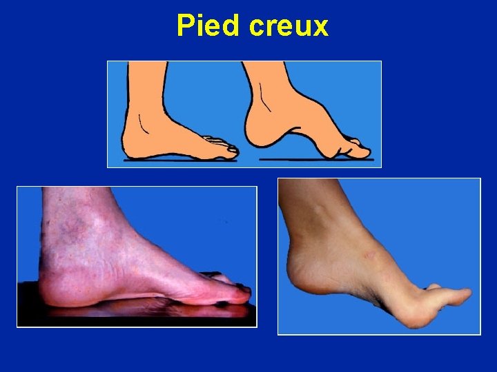 Gnralits Anatomie Rappel Examen du pied Pied plat