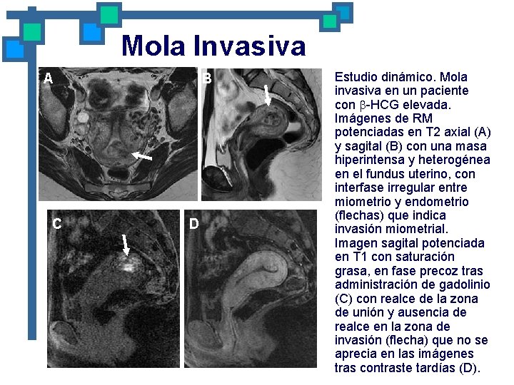 RM y correlacin anatomopatolgica en la enfermedad trofoblstica