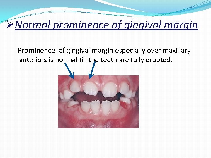 NORMAL PERIODONTIUM AND GINGIVAL DISEASES IN CHILDREN INTRODUCTION