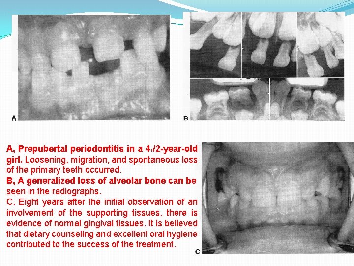 NORMAL PERIODONTIUM AND GINGIVAL DISEASES IN CHILDREN INTRODUCTION