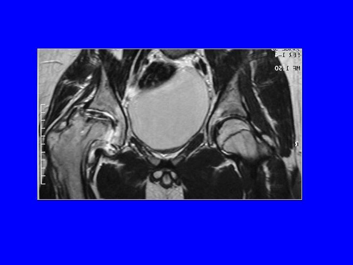 piphysiolyse de la hanche Glissement progressif ou rapide