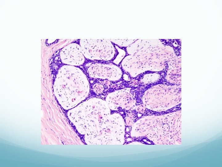 CLASS 6 18082015 2 INTRAMAMMARY MASTITIS BREAST ABSCESS