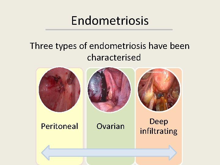 Endometriosis Jolanta Zegarska Chair and Clinic of Obstetrics
