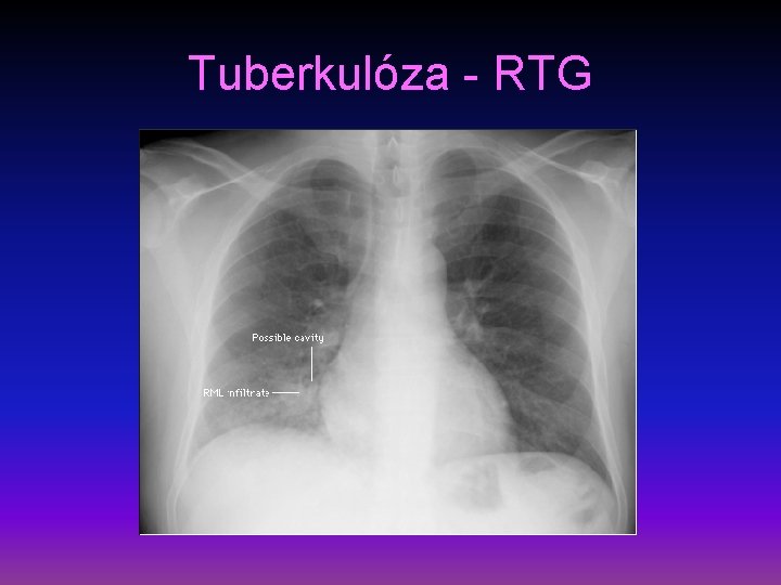 Pneumologie IV Tuberkulza Intersticiln procesy a plicn fibrzy