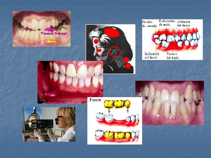 AJUSTE OCLUSAL POR DESGASTE SELECTIVO Facultad de Odontologa