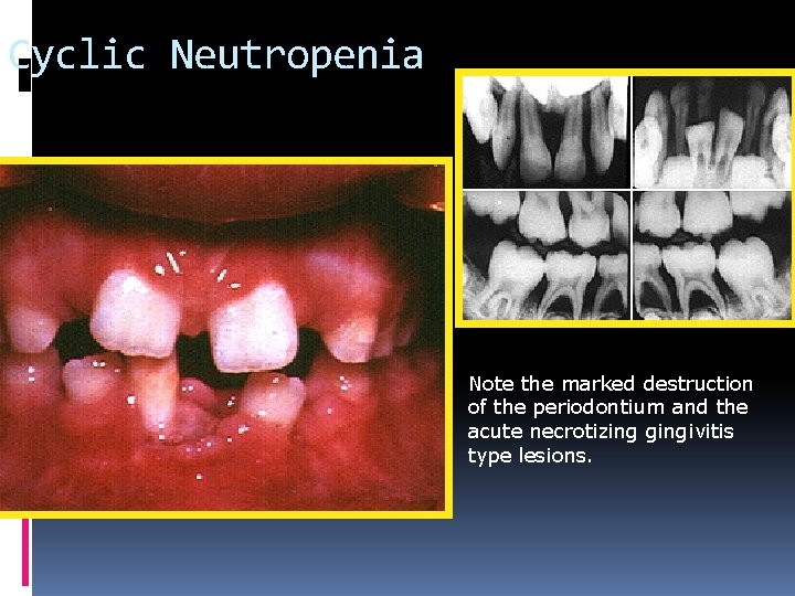 PERIODONTITIS AS A MANIFESTATION OF SYSTEMIC DISEASES By
