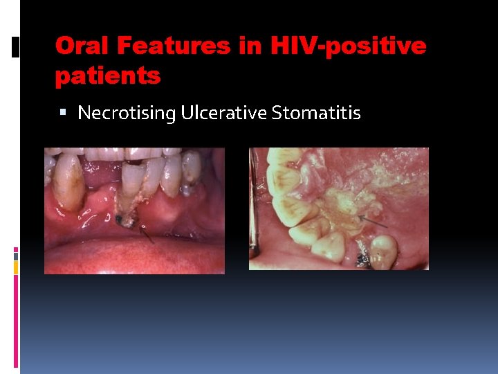 PERIODONTITIS AS A MANIFESTATION OF SYSTEMIC DISEASES By
