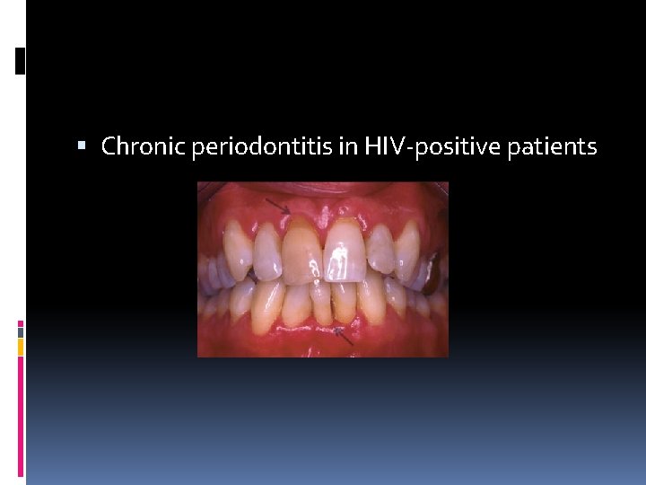 PERIODONTITIS AS A MANIFESTATION OF SYSTEMIC DISEASES By