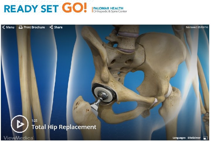 Advances in Hip Arthroplasty James Bried M D