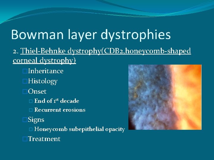 Corneal dystrophies Corneal dystrophies Group of progressive usually