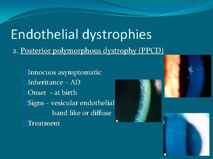 Corneal dystrophies Corneal dystrophies Group of progressive usually