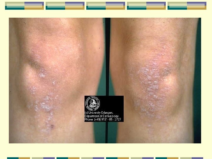 LE PSORIASIS DR F LONCHAMPT LE PSORIASIS Dermatose