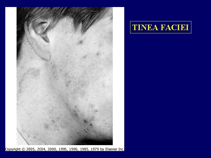 DERMATOFITOSI I DERMATOFITI sono funghi capaci di invadere