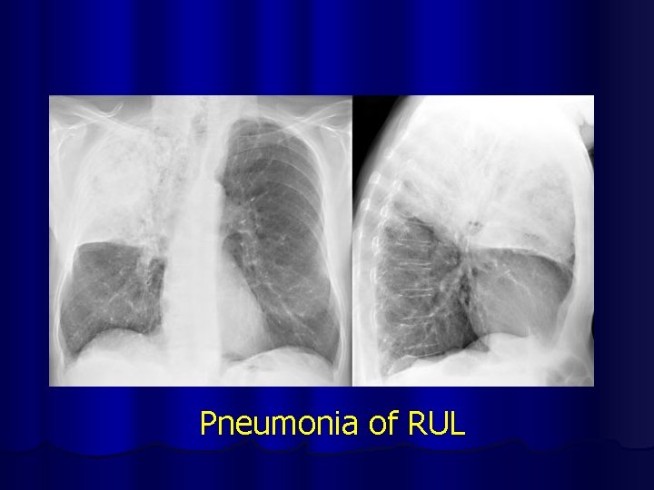 SECONDARY LOBULE l Normal lung histology l Inflammatory