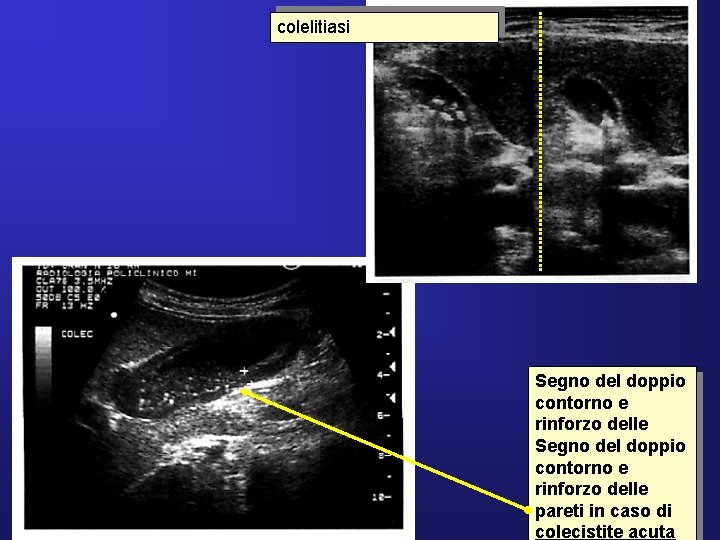 CALCOLOSI della COLECISTI colelitiasi Patologia ad elevata epidemiologia