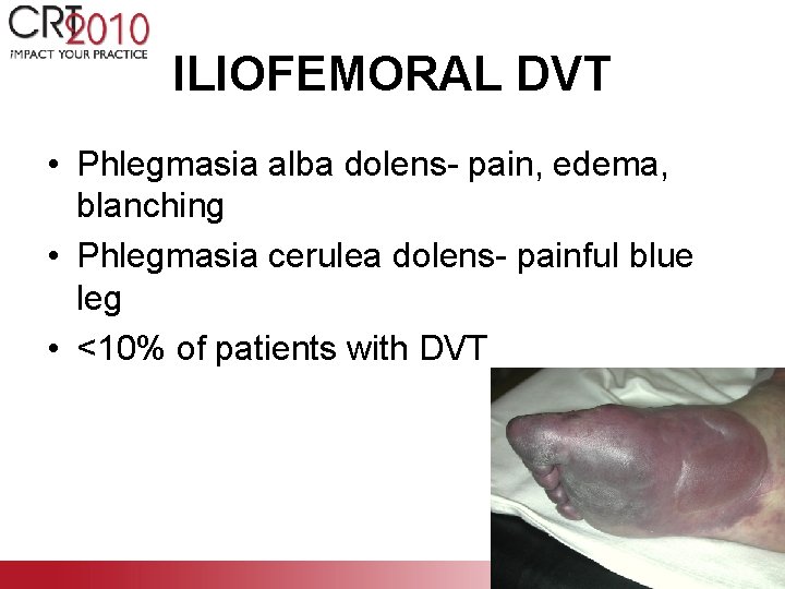 Current Standards for Treatment of DVT Rabih A