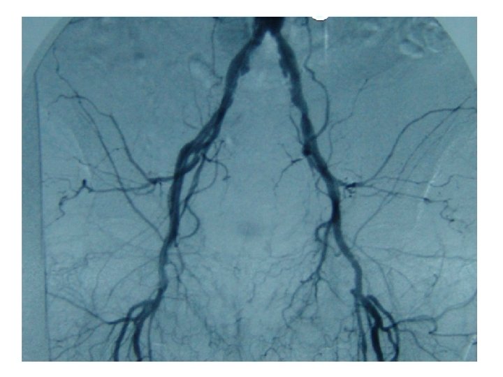 Catheter Based Percutaneous Coronary Angiography The Byrne Identity