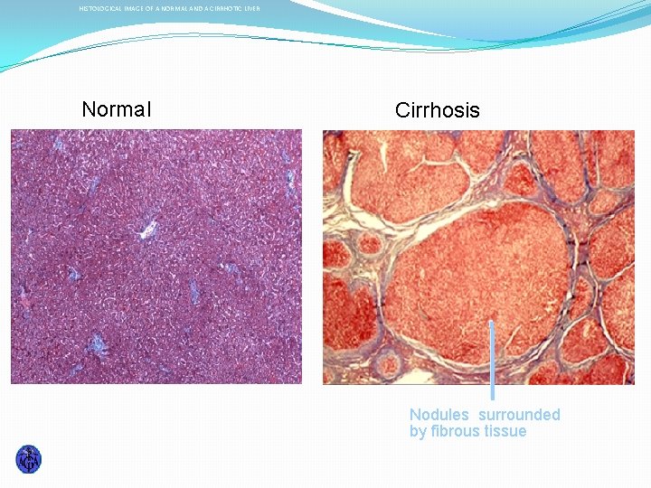 Liver Cirrhosis 1 Prof Mohamed Elhasafi Hepatology Unit