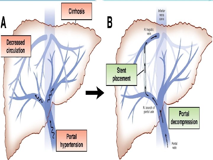 Liver Cirrhosis 1 Prof Mohamed Elhasafi Hepatology Unit