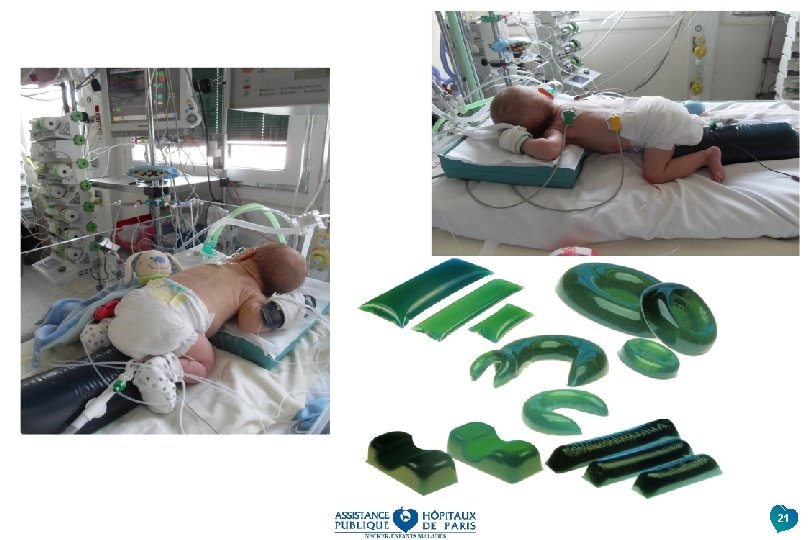 Suivi en ranimation chirurgie cardiaque pdiatrique Vronique MOUNY