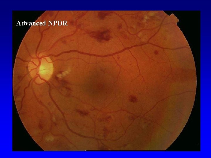 Diabetic retinopathy diagnostics therapy classification Diabetes ...