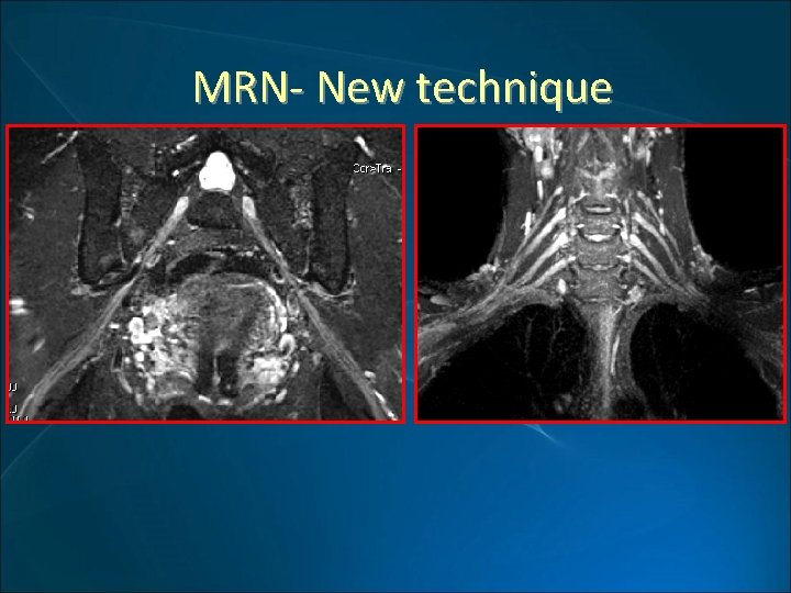 High Resolution MR Neurography Evaluation Of Radiculopathy Avneesh