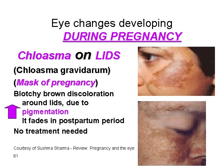 Eye manifestations during pregnancy By Dr Mohamed Abusharifa