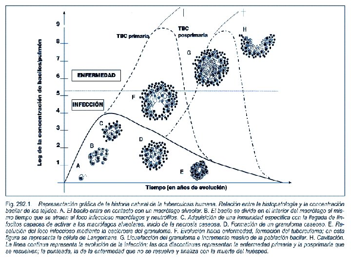 TUBERCULOSIS PULMONAR TUBERCULOSIS PULMONAR Aspectos bsicos ...