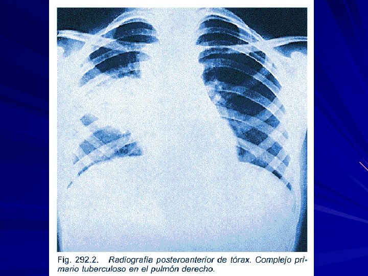 TUBERCULOSIS PULMONAR TUBERCULOSIS PULMONAR Aspectos bsicos ...
