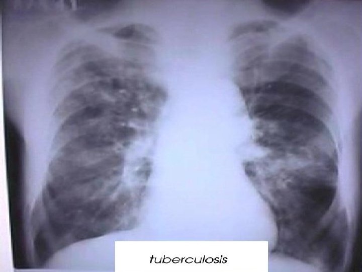 TUBERCULOSIS PULMONAR TUBERCULOSIS PULMONAR Aspectos bsicos ...