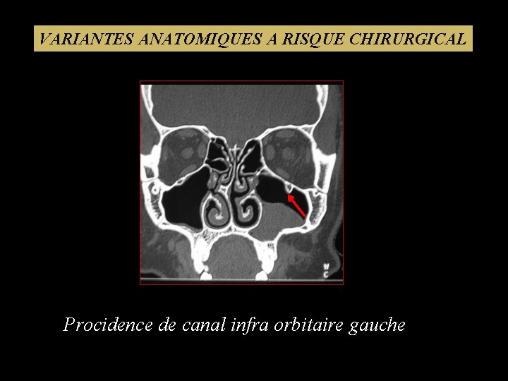 ILLUSTRATION TDM DES VARIANTES ANATOMIQUES DES SINUS DE ILLUSTRATION TDM DES VARIANTES ANATOMIQUES DES SINUS DE