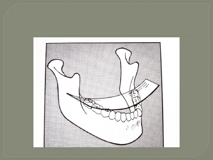 Setting posterior teeth Dr Nesreen Salim Factors affecting