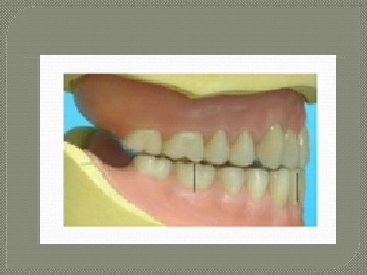 Setting posterior teeth Dr Nesreen Salim Factors affecting