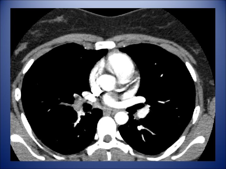 Moderate Pulmonary Embolism Treated with Thrombolysis MOPETT Trial