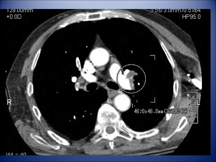 Moderate Pulmonary Embolism Treated with Thrombolysis MOPETT Trial