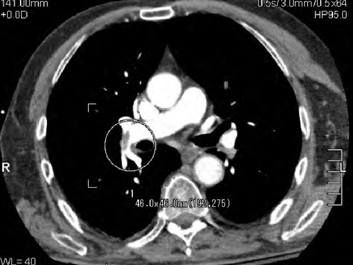 Moderate Pulmonary Embolism Treated with Thrombolysis MOPETT Trial