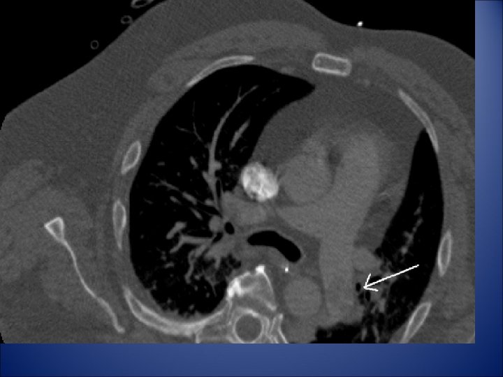 Moderate Pulmonary Embolism Treated with Thrombolysis MOPETT Trial