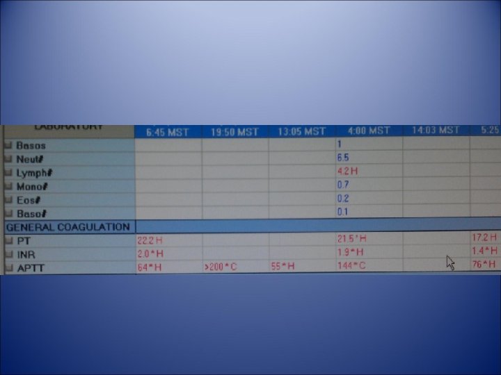 Moderate Pulmonary Embolism Treated with Thrombolysis MOPETT Trial