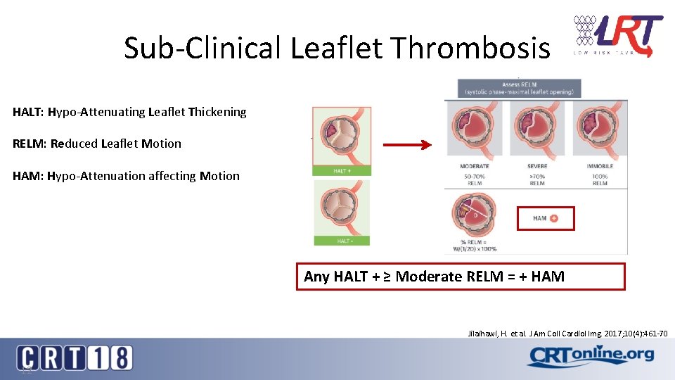 Transcatheter Aortic Valve Replacement for Patients with Severe