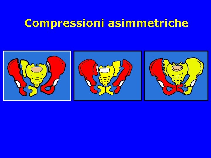 FRATTURE DI BACINO Classificazione delle fratture di bacino