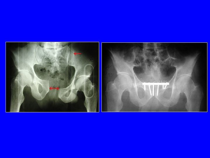 FRATTURE DI BACINO Classificazione delle fratture di bacino