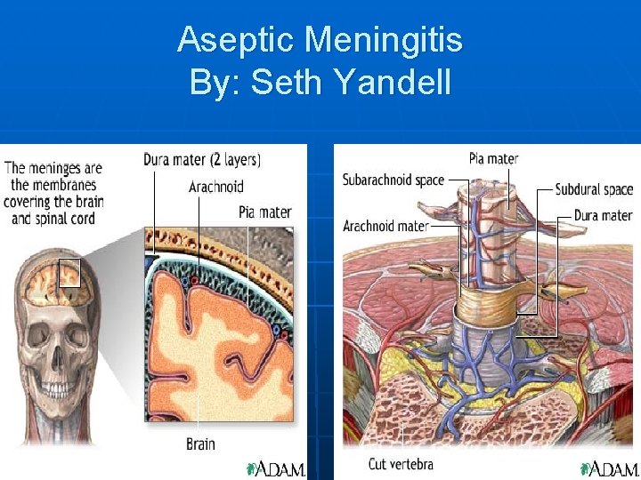 Aseptic Meningitis By Seth Yandell Case Presentation n