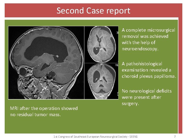 Combined microsurgical and endoscopic removal of large brain